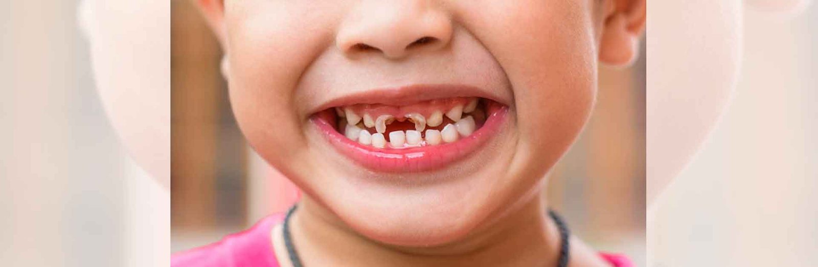 These 4 Avoidable Mistakes That Can Prevent Cavities In Kids These 4 Avoidable Mistakes That Can Prevent Cavities In Kids